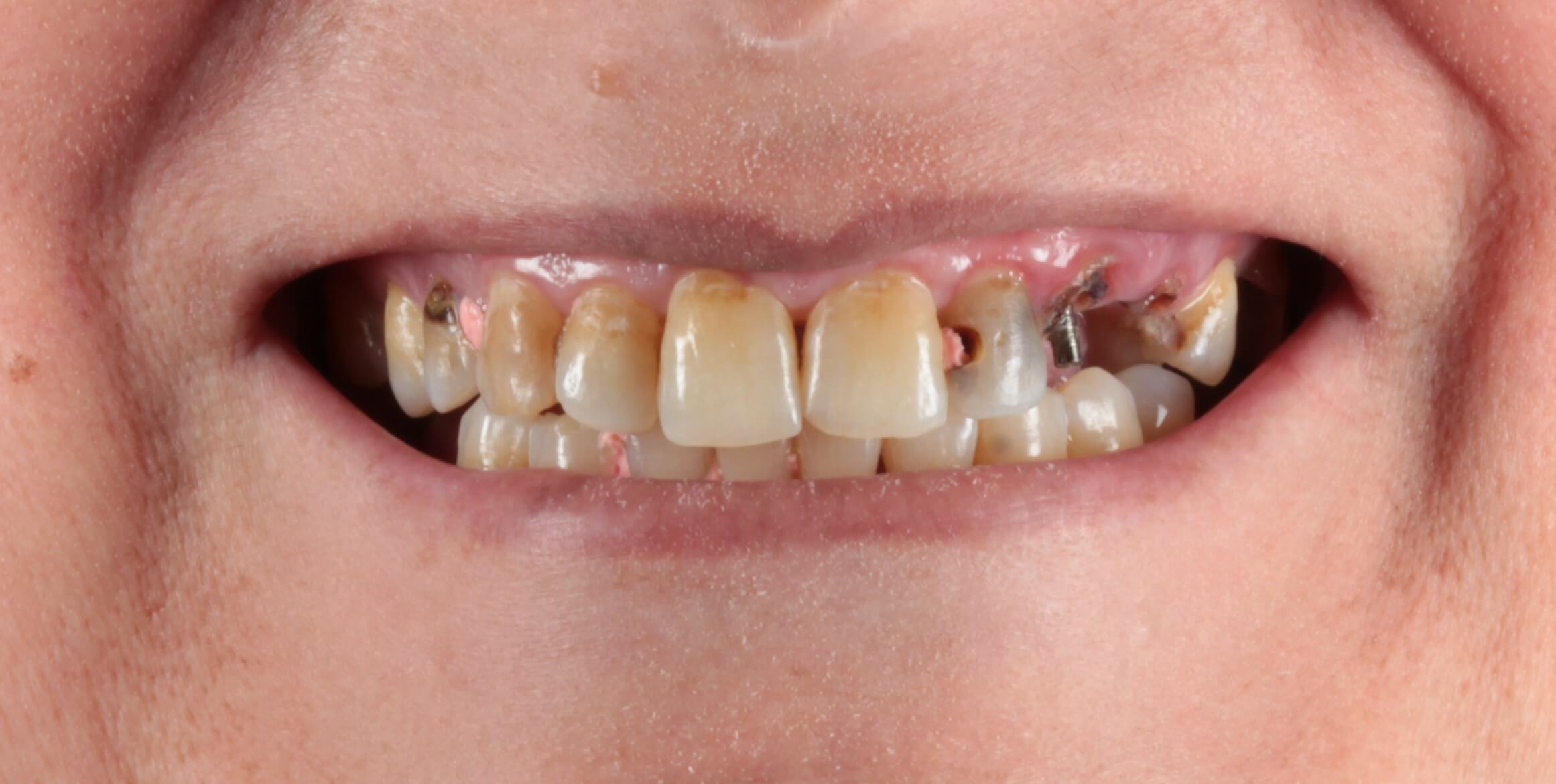Legends Dental — Premium Cosmetic & Implant Dentistry in Gregory Hills